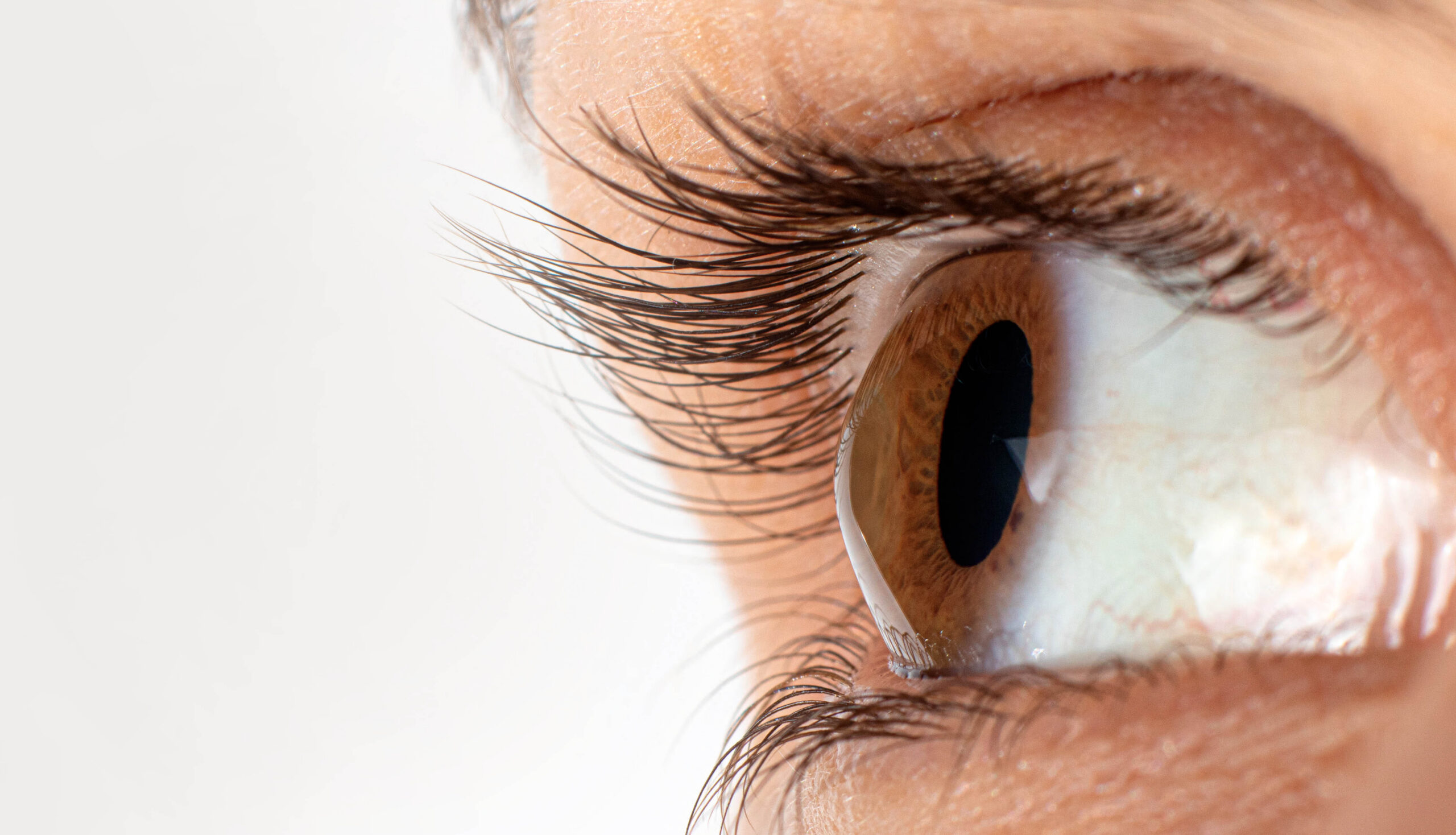 Córnea Guttata y Distrofia de Fuchs - Oftalclinic